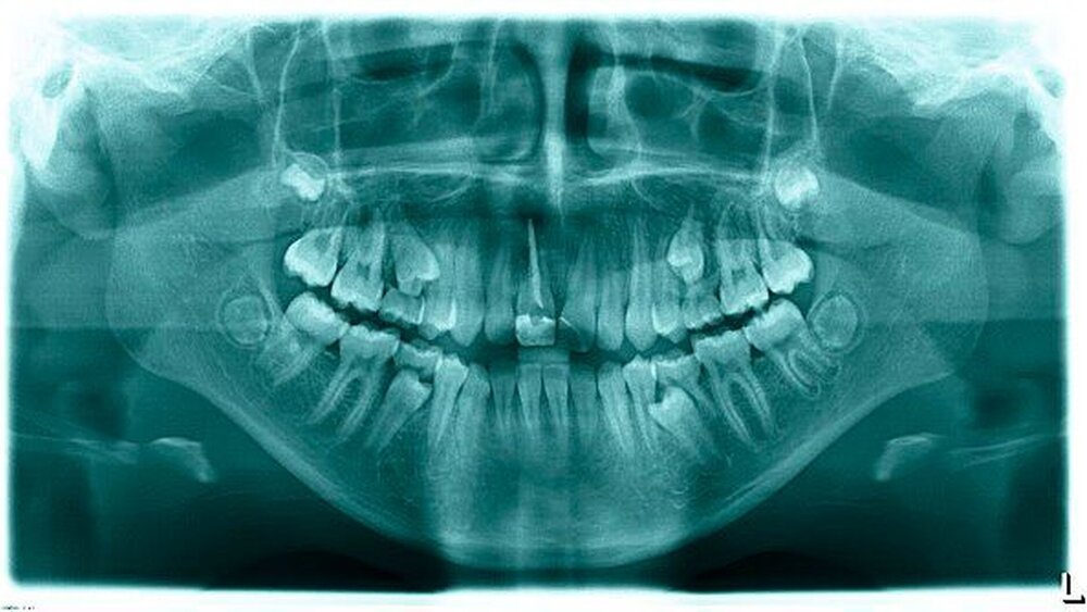 Therapie des dentalen Traumas bleibender Zähne - zm-online