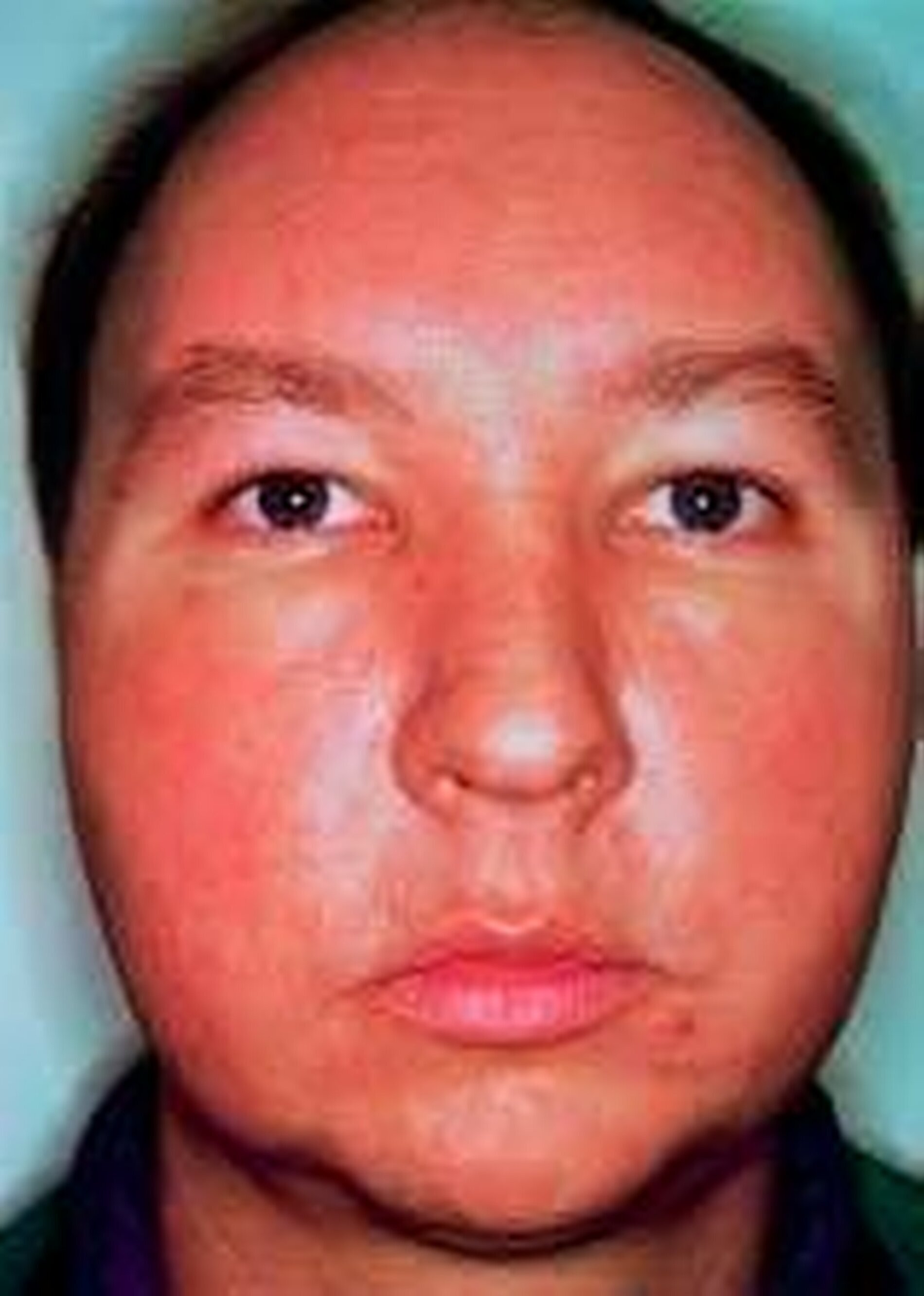 Bei chronischer Gesichtsschwellung an den Morbus Morbihan denken - zm ...