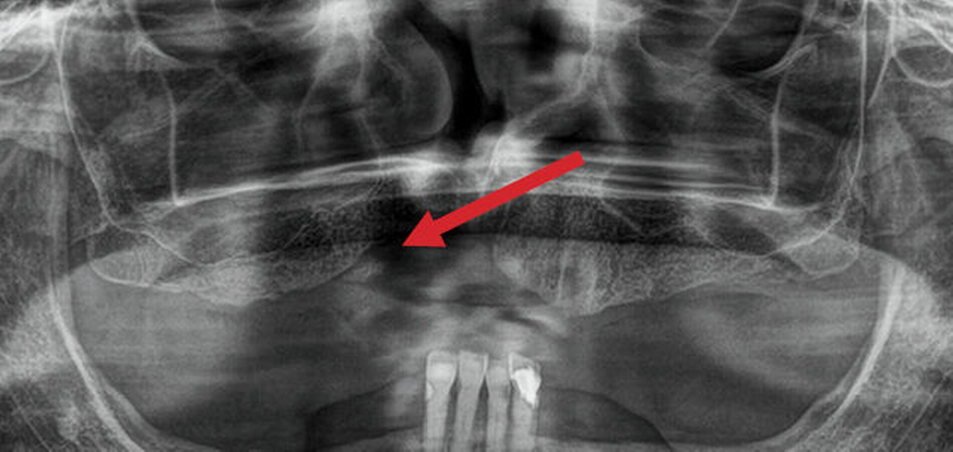 Das dentale MRT in der Diagnostik der Kieferosteonekrose - zm-online