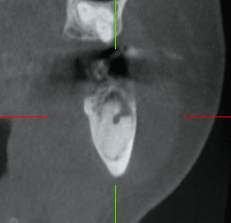 Das ossifizierende Fibrom – ein seltener, gutartiger Knochentumor im ...