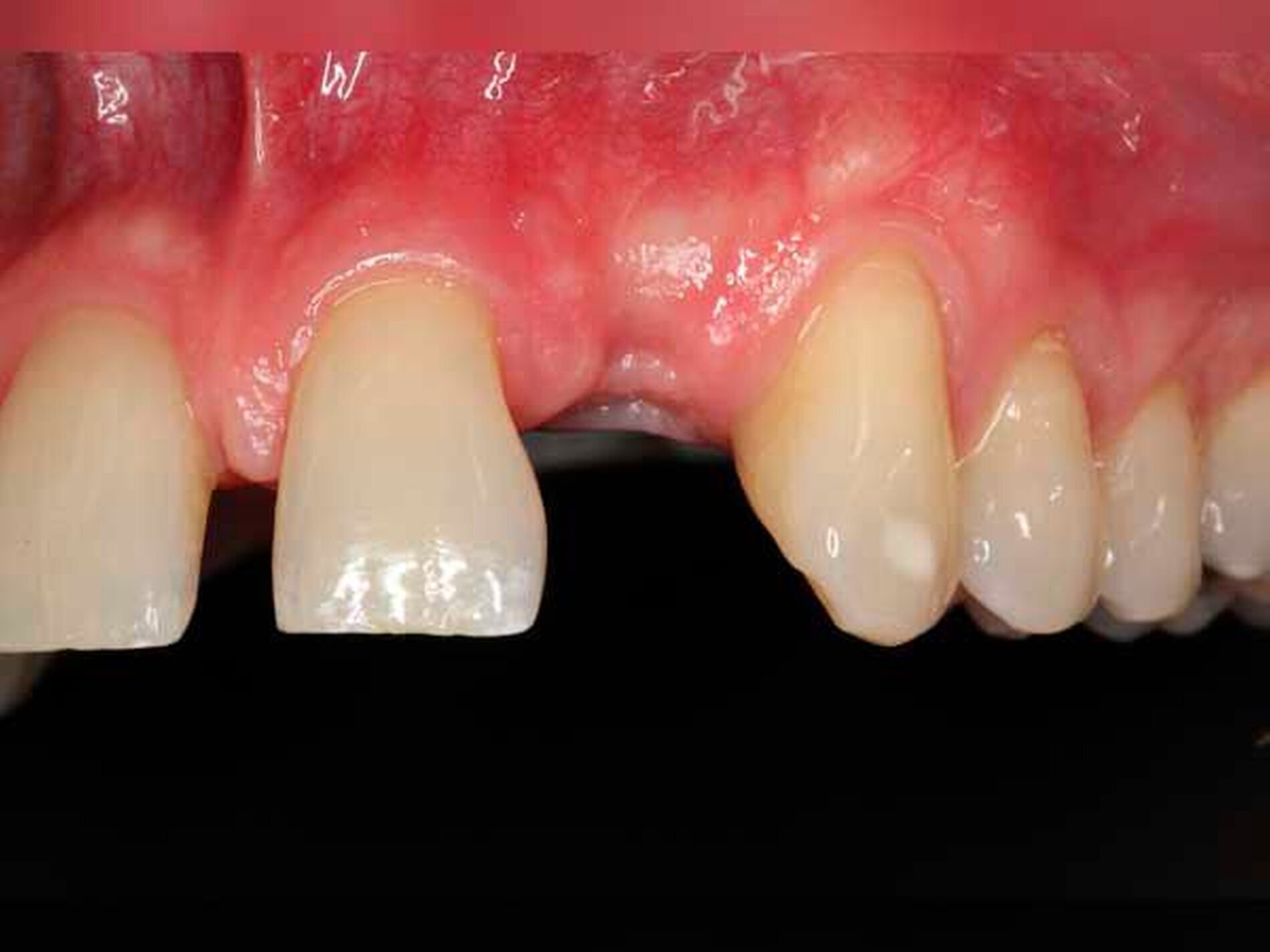 Tooth-shell-technique: Kieferkammaugmentation mit autologem Dentin - zm ...