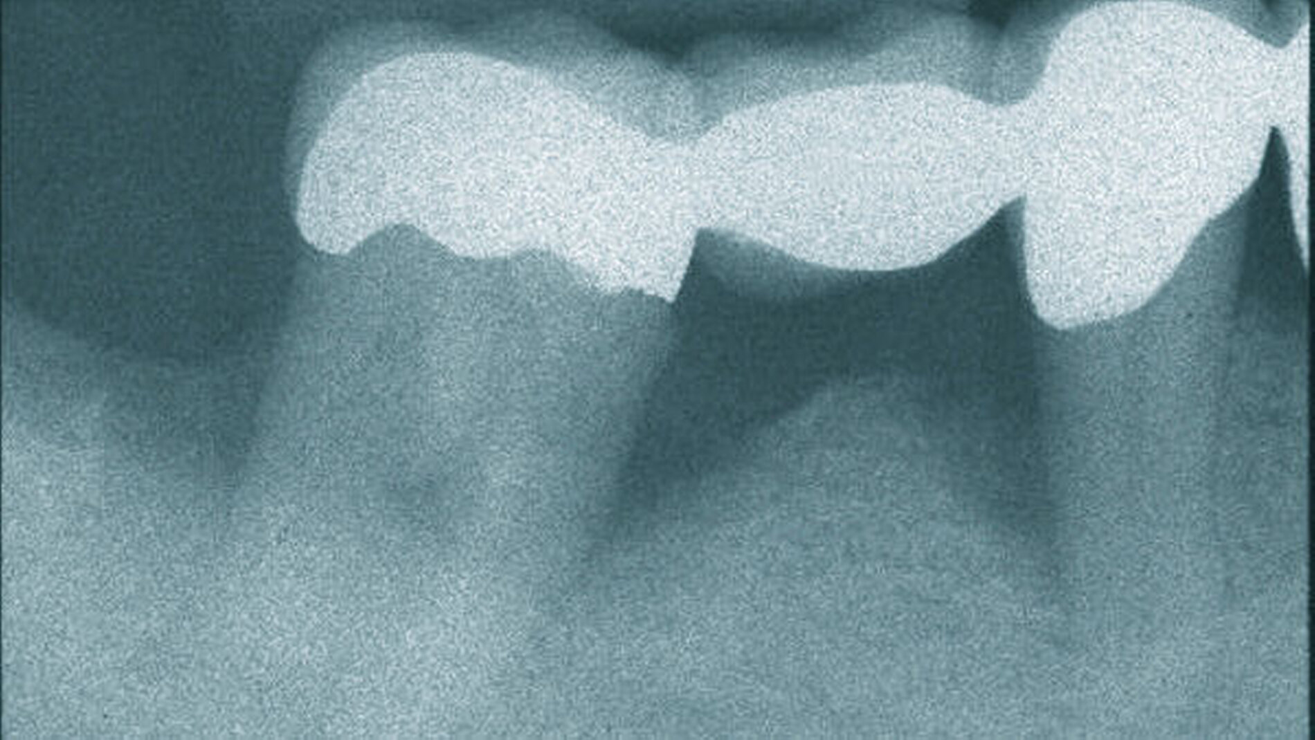 Lange Zähne - was hilft? - zm-online