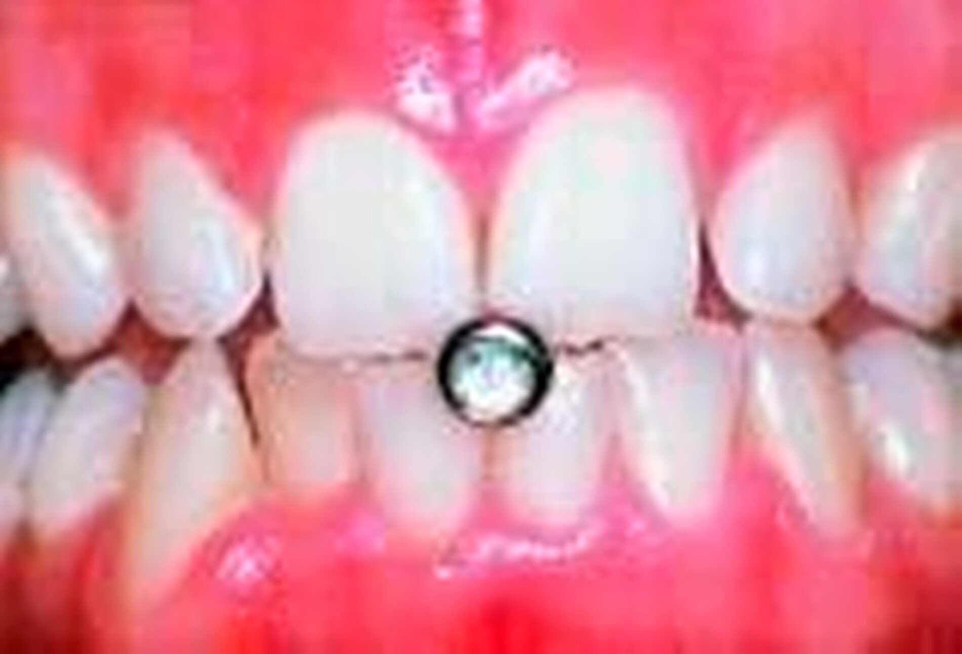 Piercing im Mundbereich - zm-online