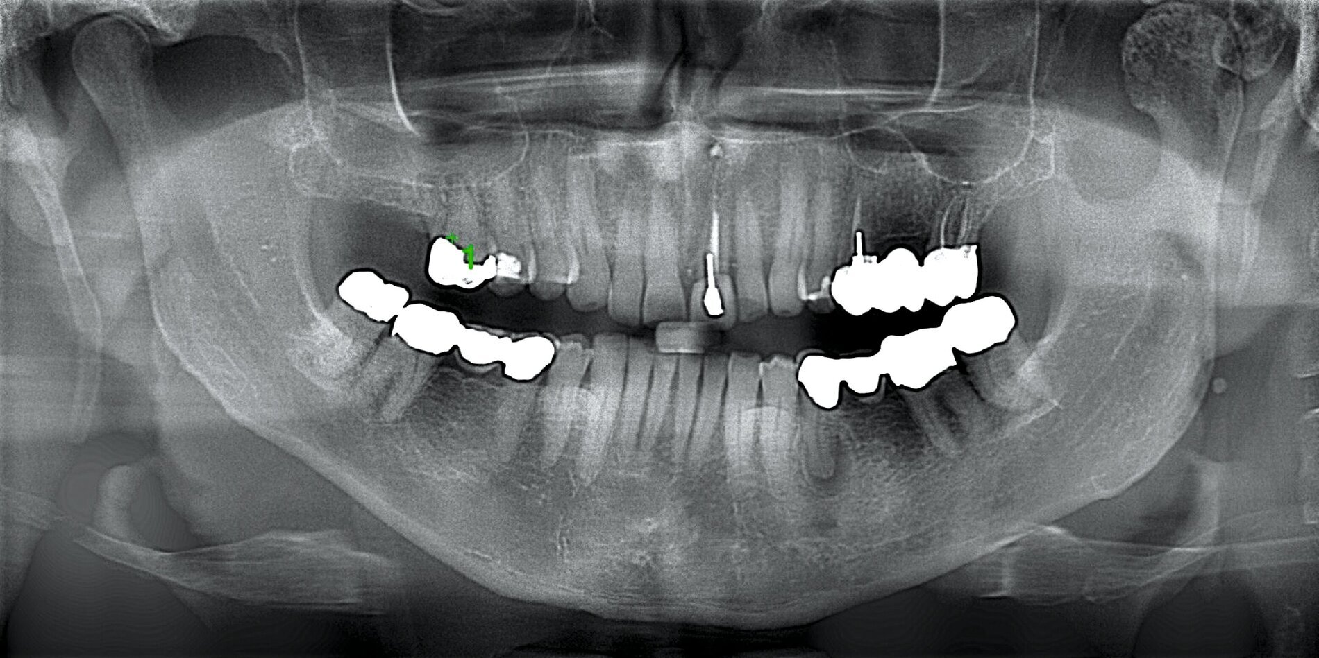 Diagnostik und Therapie bei benignen Kiefergelenkstumoren - zm-online
