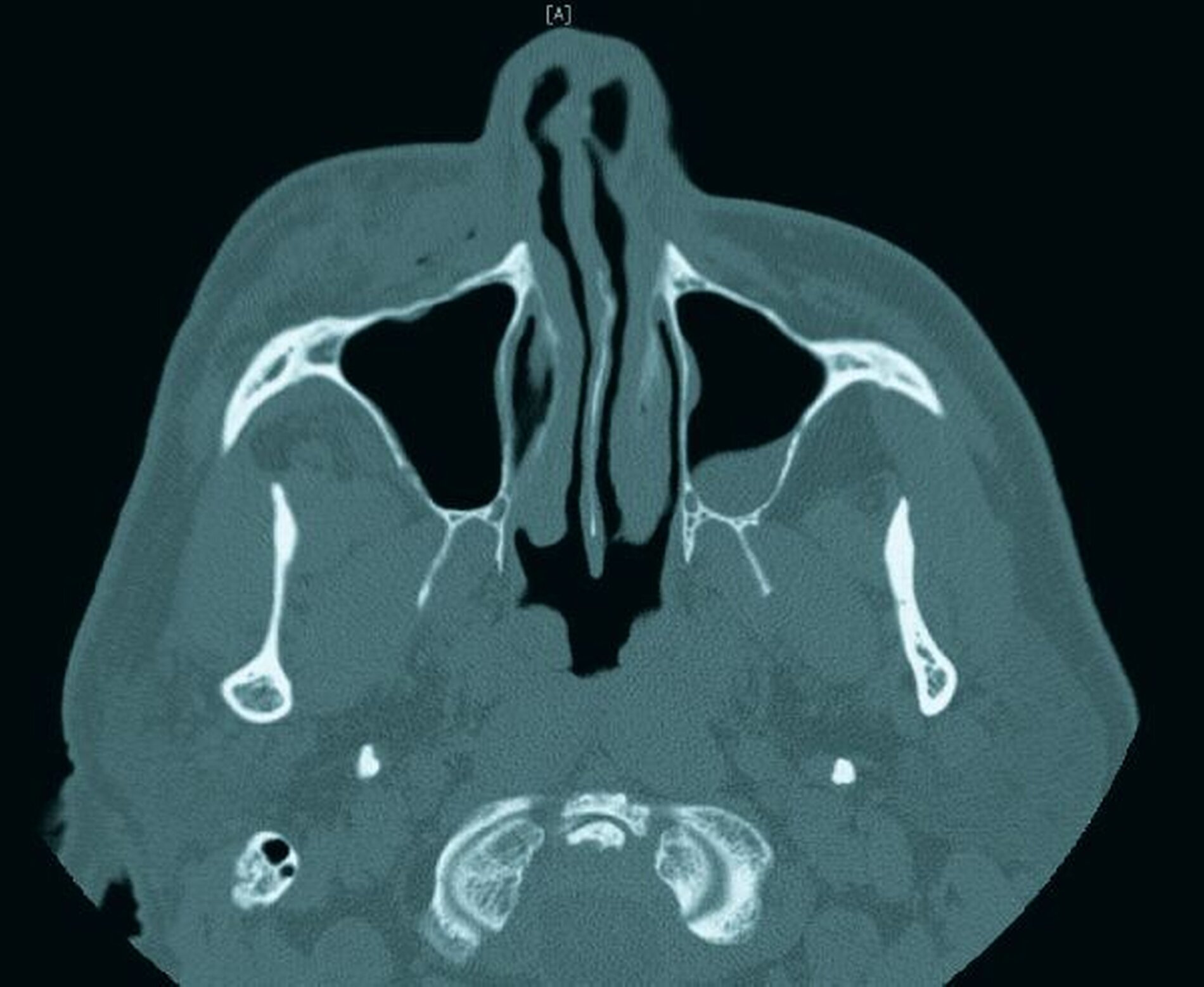 Weichteilemphysem nach endodontischer Behandlung - zm-online