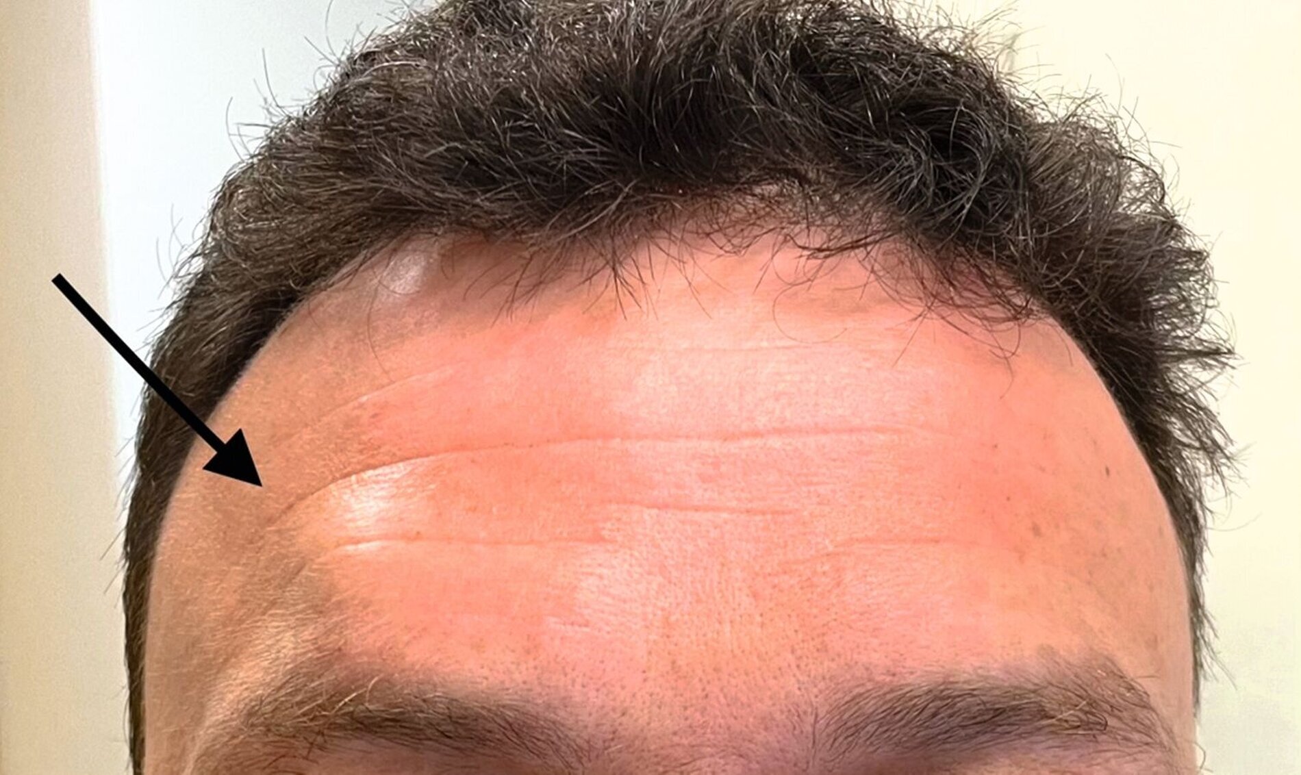 Vaskuläre Anomalie des Os frontale - zm-online