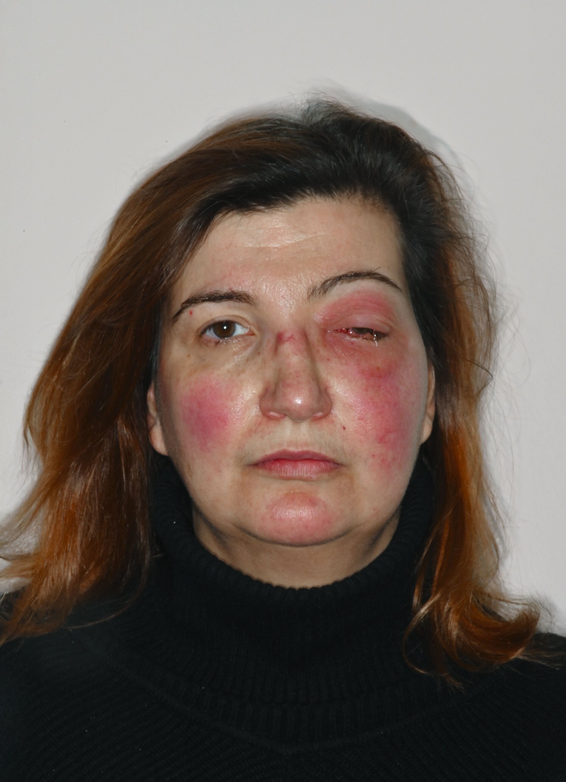 Orbitale Komplikation bei odontogener Sinusitis - zm-online