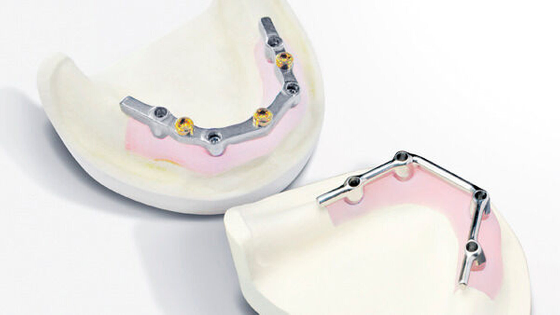 Permadental: Gefräste Stege auf Implantaten - zm-online