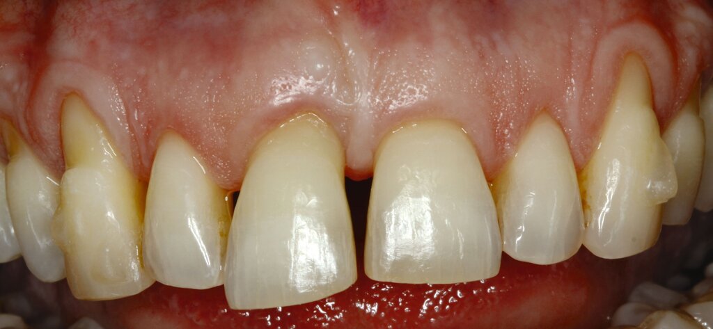 Die Schienung von Zähnen im Rahmen der Parodontitistherapie - zm-online