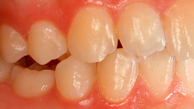 Der Fall: Persistierender Milchmolar - zm-online