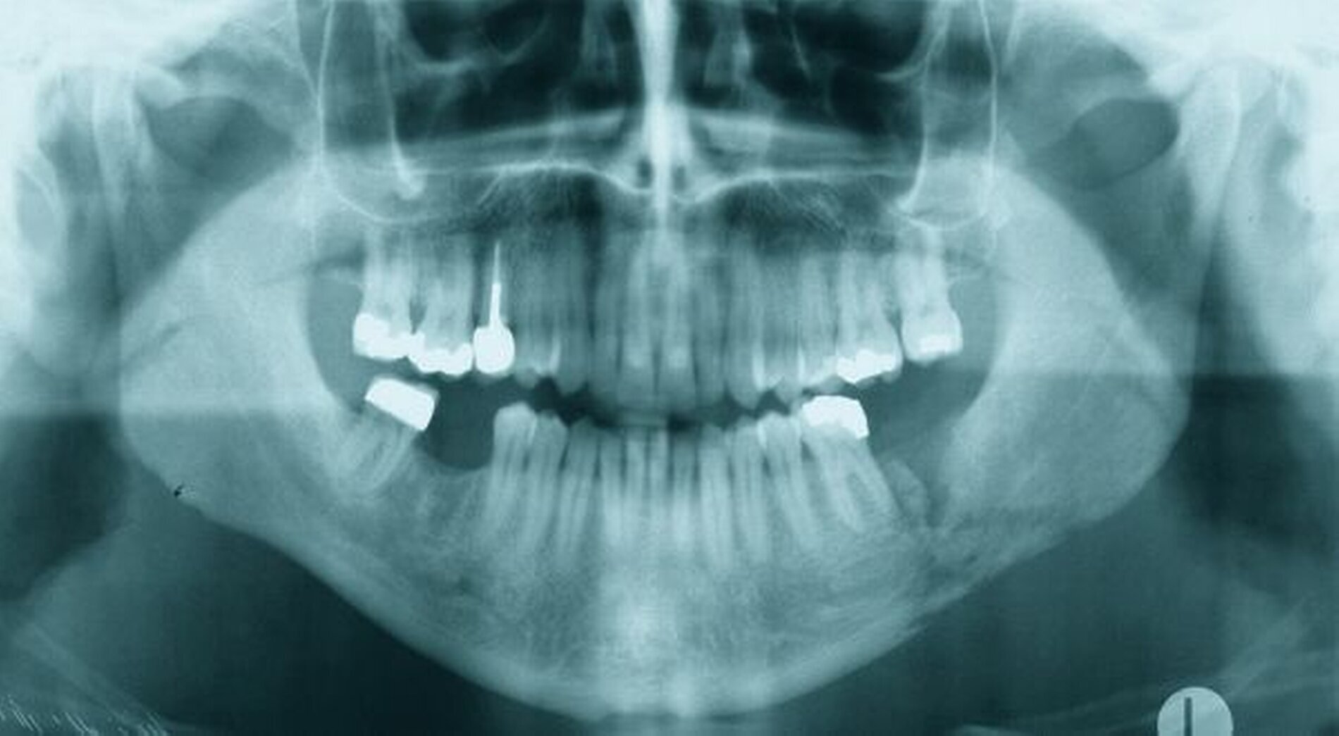 Pathologische Fraktur bei Osteomyelitis des Unterkiefers - zm-online
