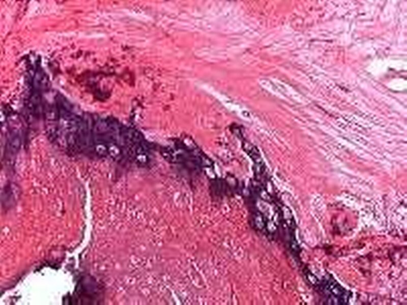 Epithelioma calcificans Malherbe (Pilomatrixom) - zm-online