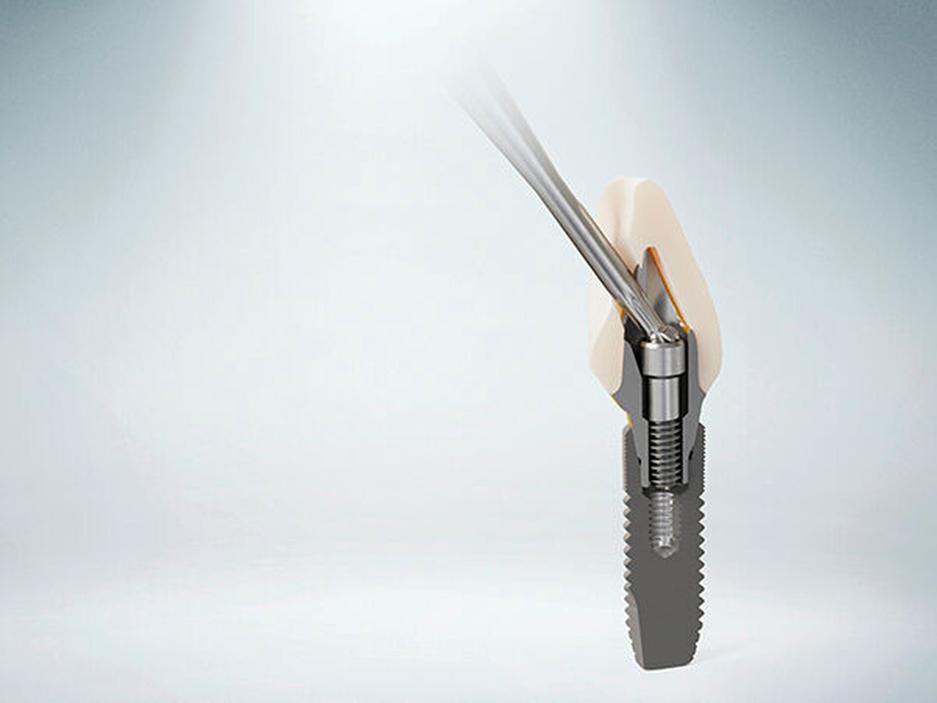 Atlantis CustomBase-Lösung mit anguliertem Schraubenzugang - zm-online