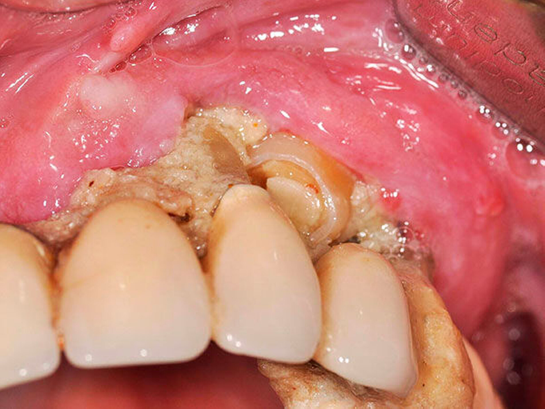 Calculus dentis: Deshalb ist die Differenzialdiagnostik notwendig! - zm ...