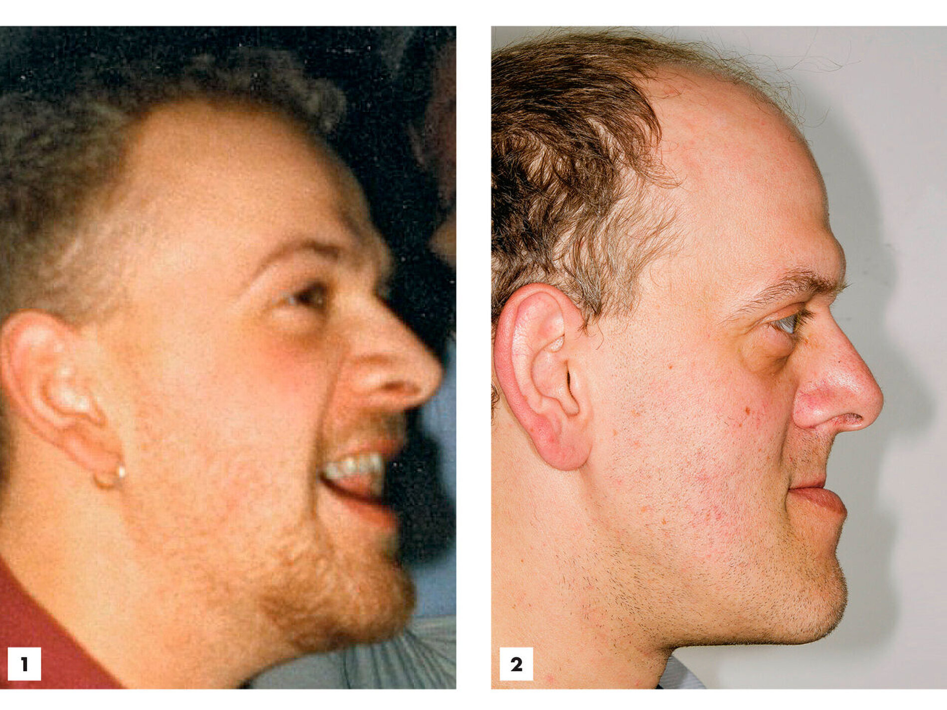 Die Behandlung einer Akromegalie-assoziierten Dysgnathie - zm-online