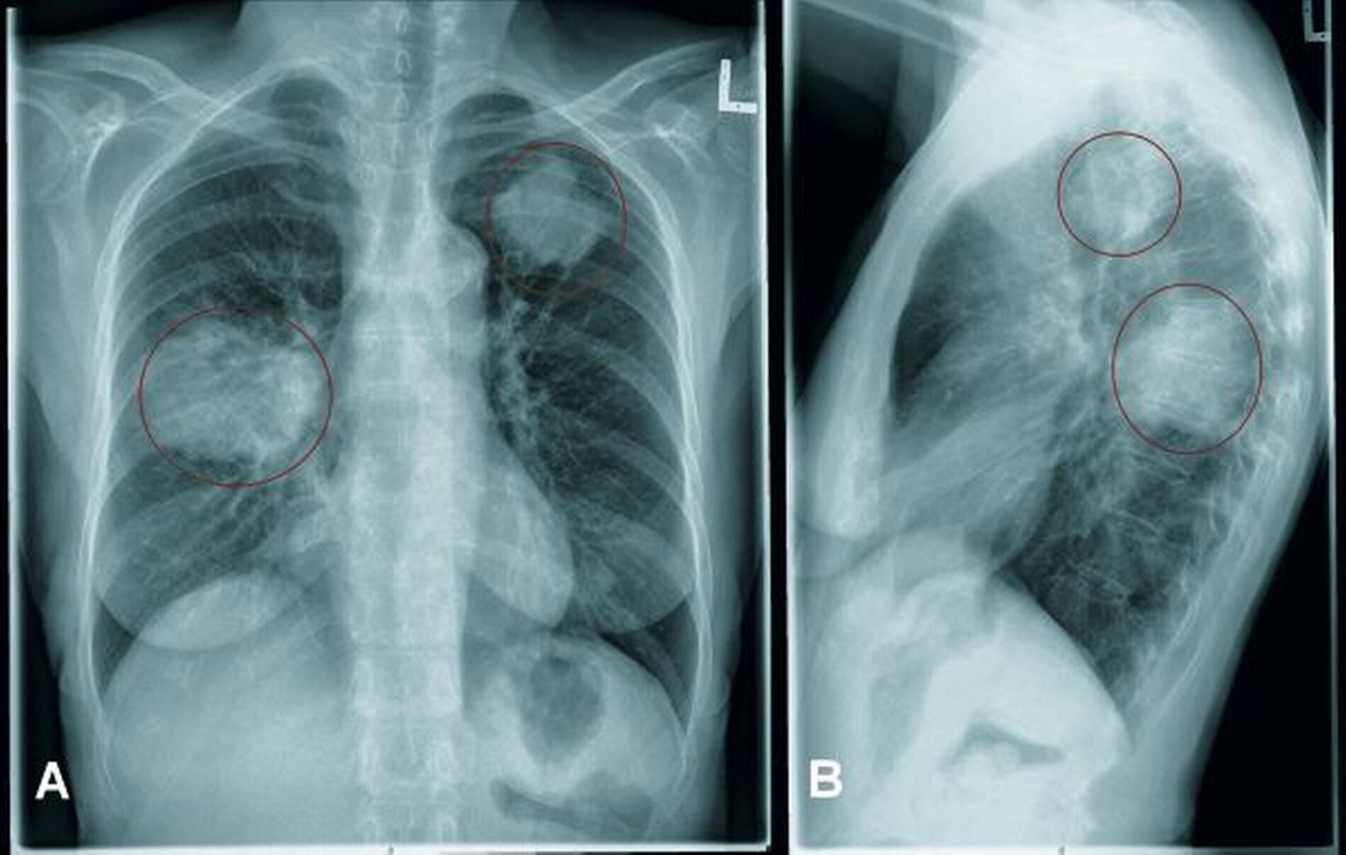 Bronchialkarzinom-Metastase im Kopf-Hals-Bereich - zm-online