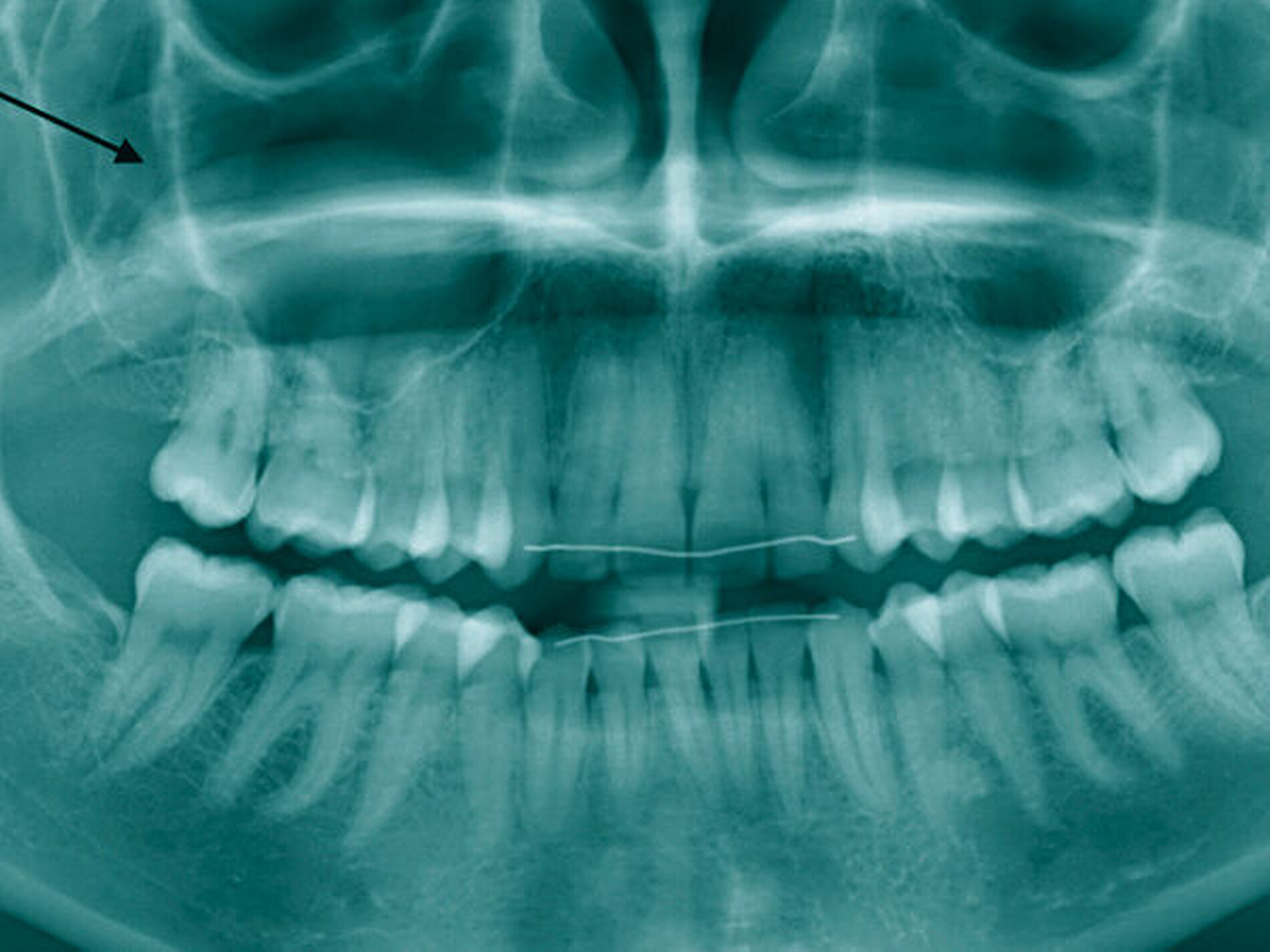 Endoskopischer Zugang zur Kieferhöhle über die Sinus-maxillaris ...