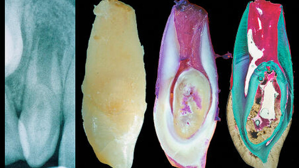 Dens invaginatus - zm-online