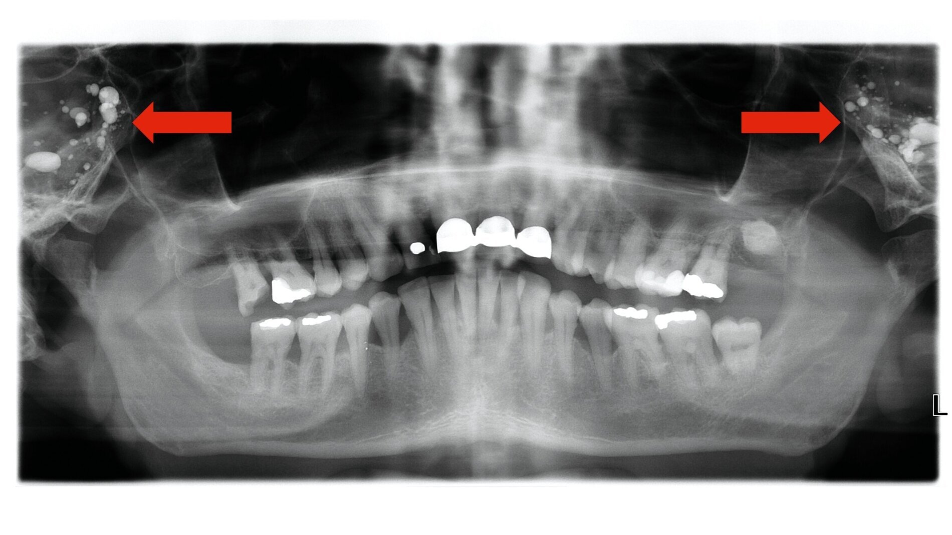 Unerwarteter Zufallsbefund im OPG: Lipiodolablagerungen - zm-online