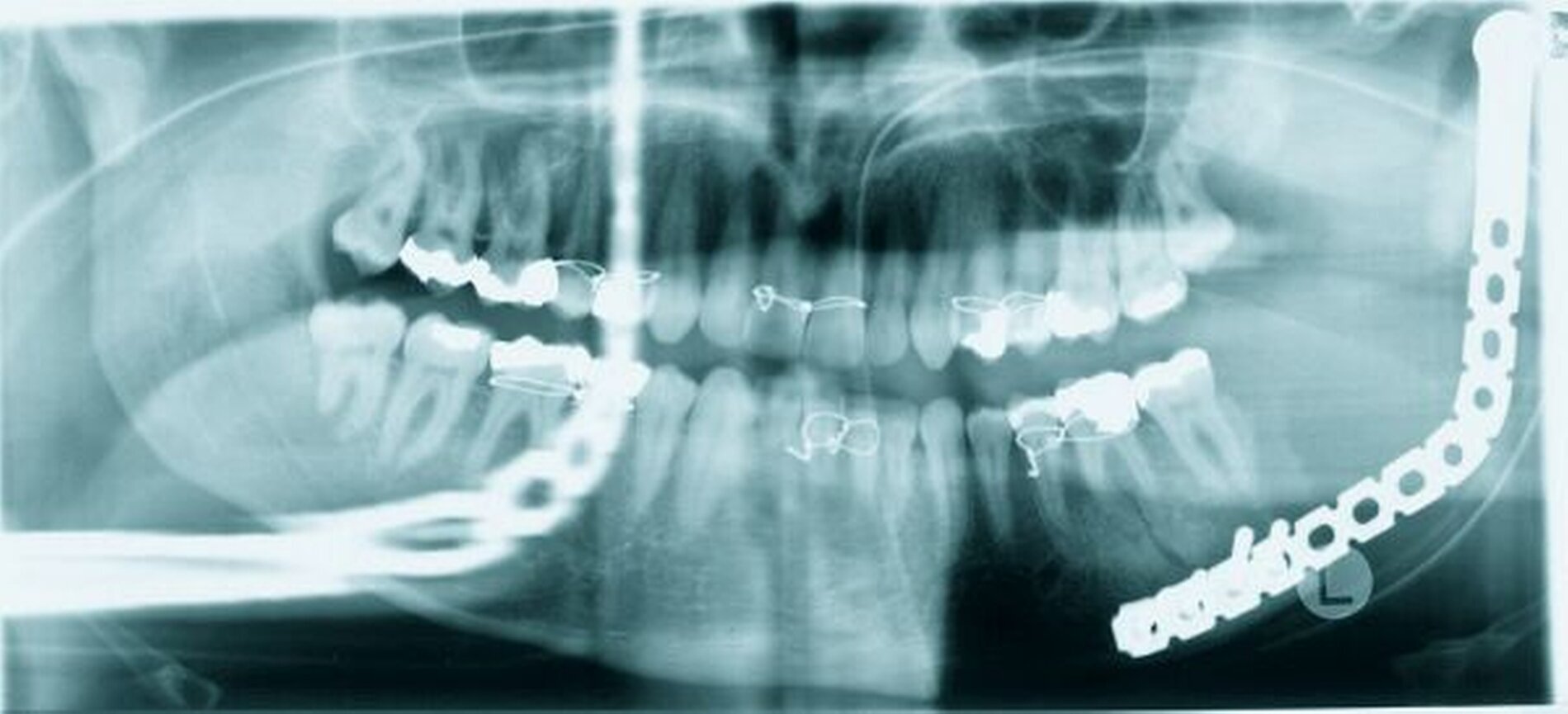 Desmoplastisches Fibrom des Ramus mandibulae - zm-online