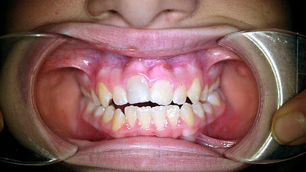 Therapie des dentalen Traumas bleibender Zähne - zm-online