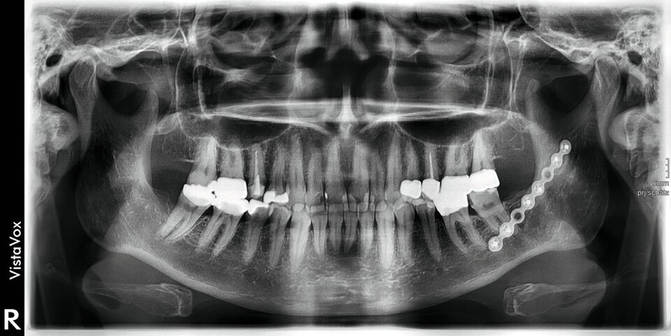 Das ossifizierende Fibrom – ein seltener, gutartiger Knochentumor im ...