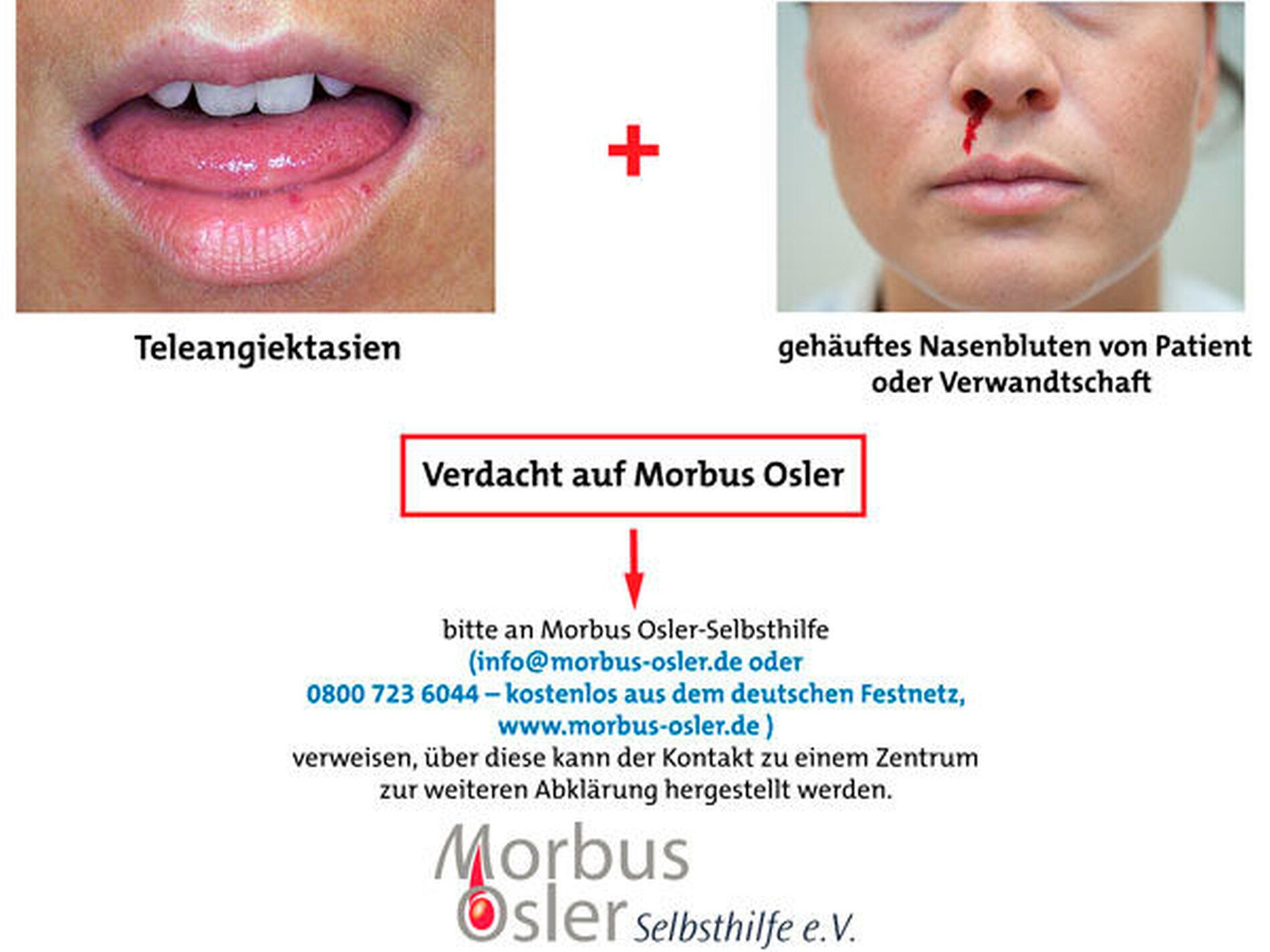 Reminder: Früherkennungsprogramm zum Morbus Osler - zm-online