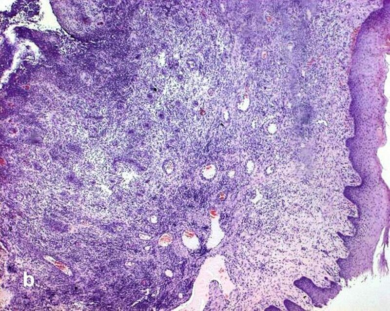 Epulis granulomatosa an einem dentalen Implantat - zm-online