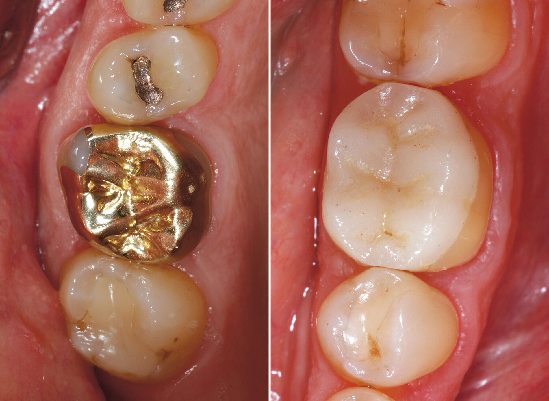 Goldguss-Teilkronen versus Keramikinlays/-onlays – was hält länger ...