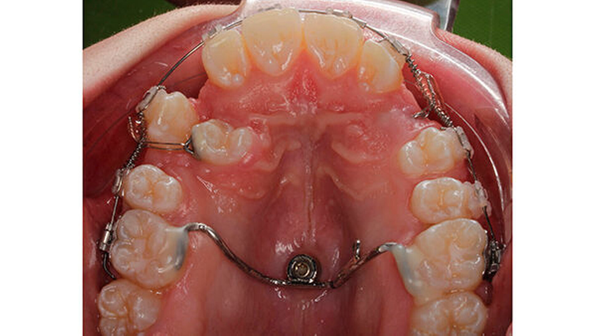Therapie verlagerter Zähne mittels Gaumenimplantat - zm-online