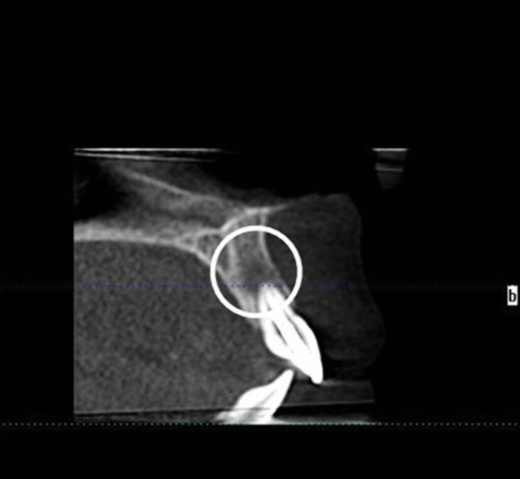 Glück im Unglück: Verlagerter 3er wird zum oberen 1er - zm-online