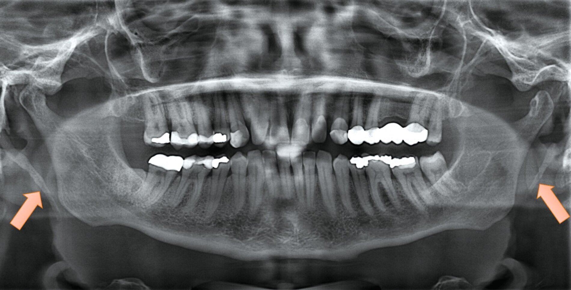Eagle-Syndrom als Ursache chronischer orofazialer Schmerzen - zm-online