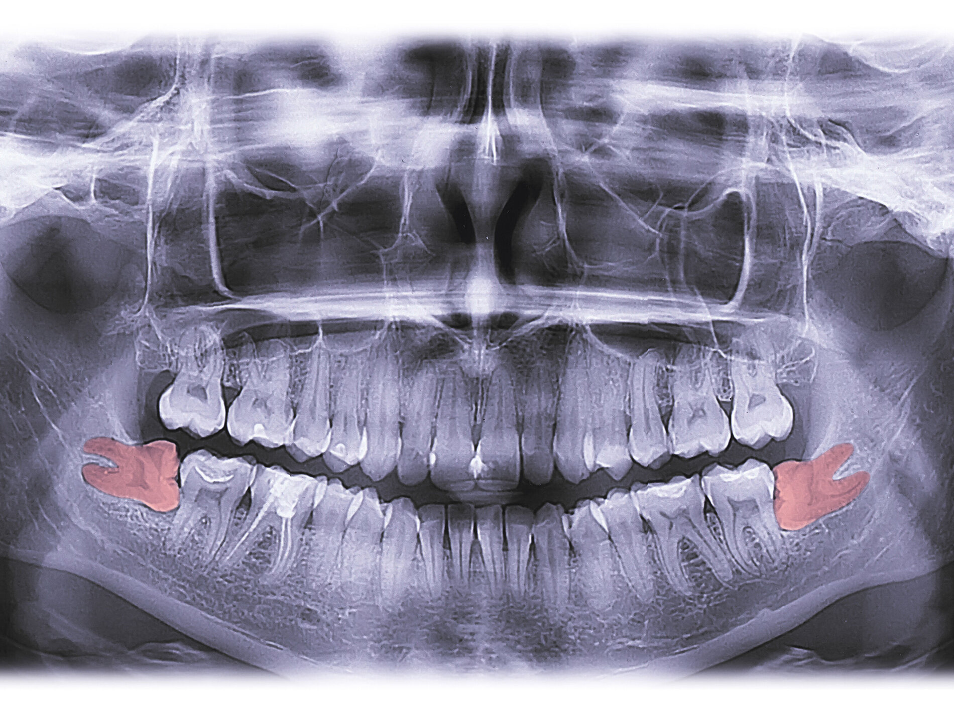 Wirksame Maßnahmen bei Alveolitis sicca - zm-online