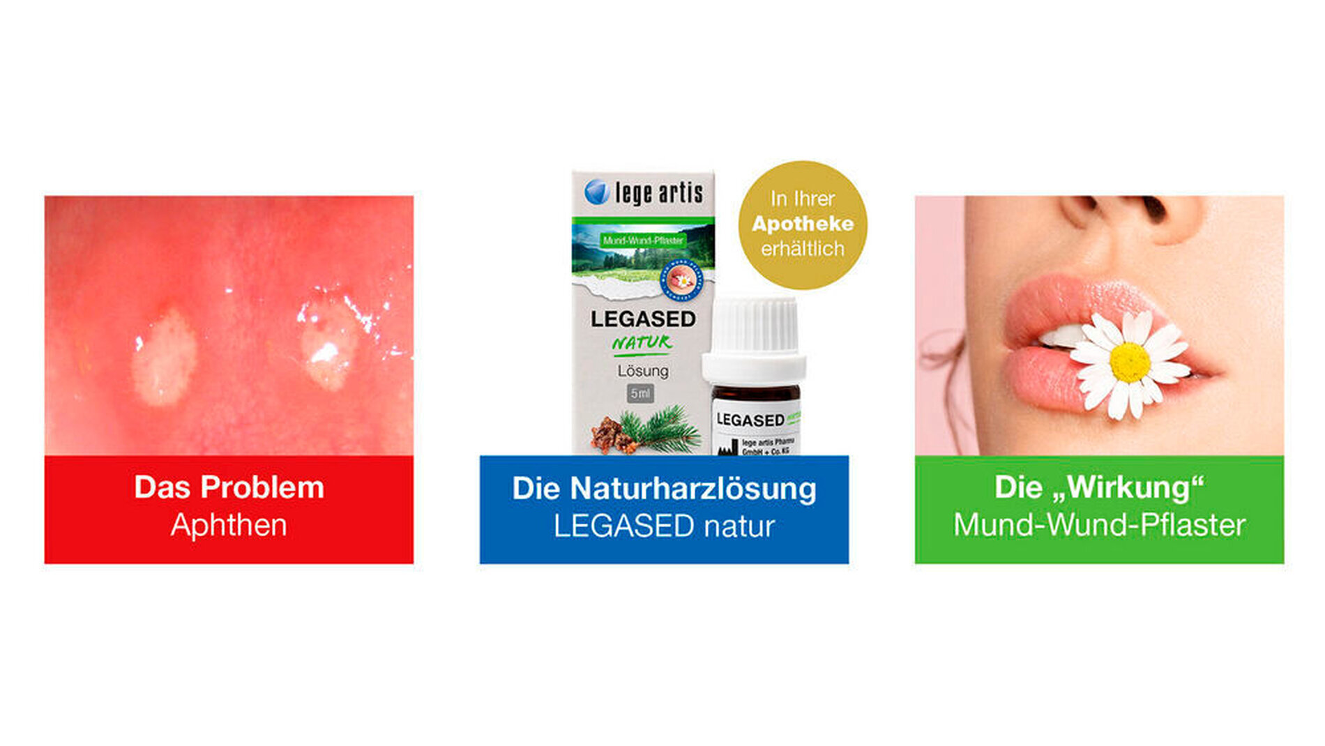 Aphthe, Apthe oder Afte? Hauptsache weg damit! - zm-online