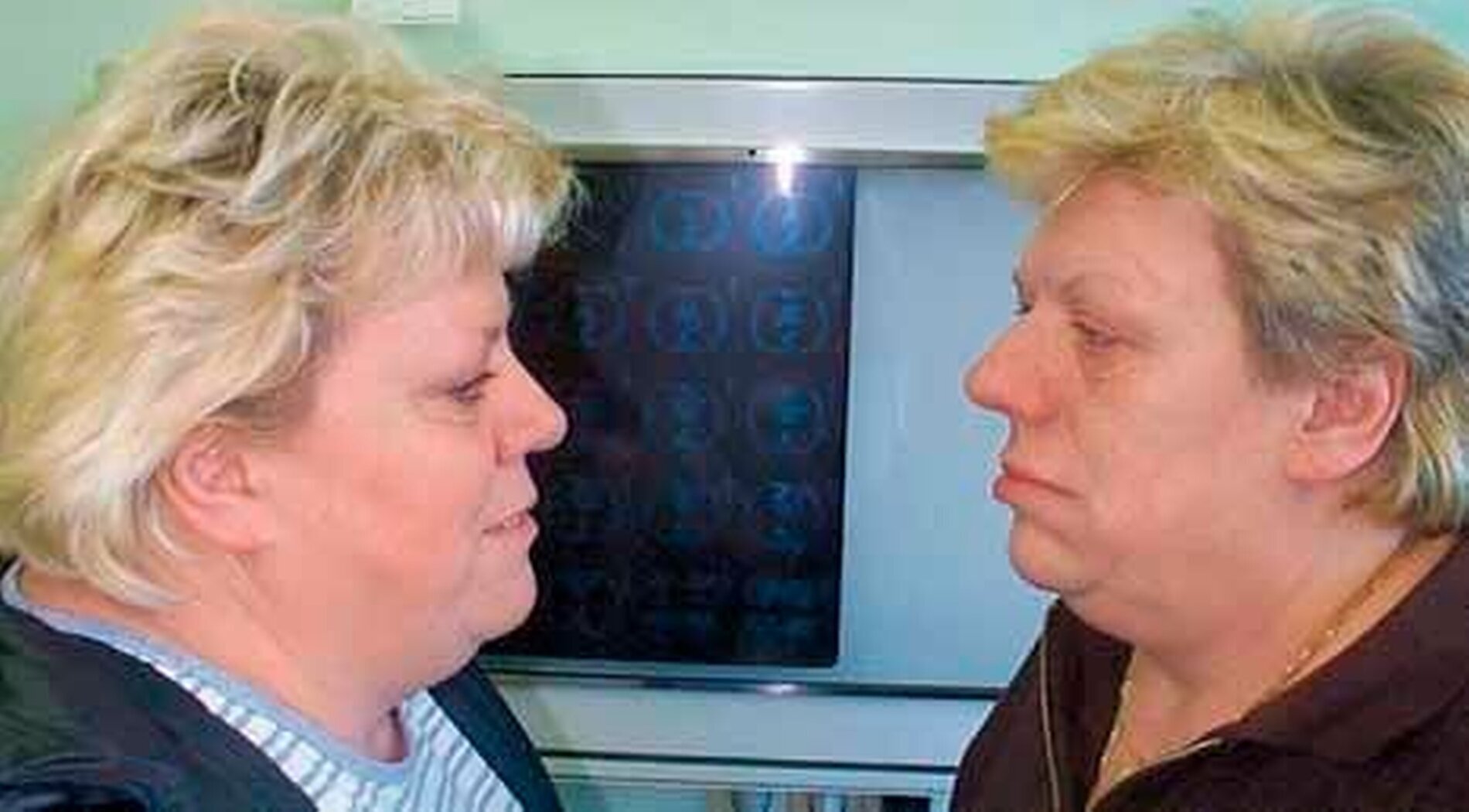 Neue Therapie der Akromegalie - zm-online