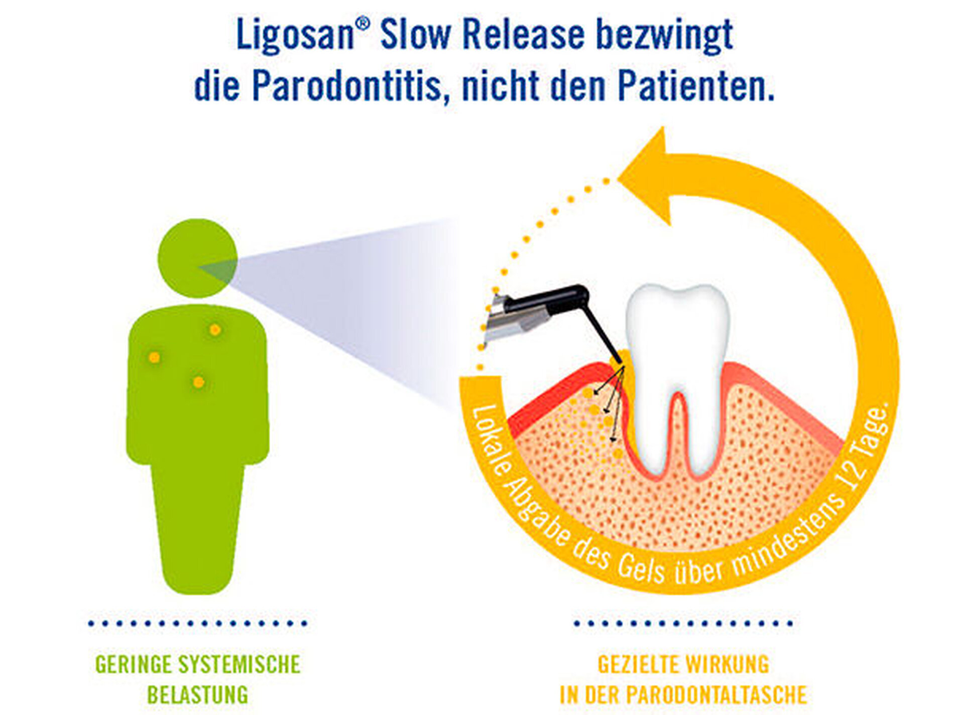 Parodontitistherapie lokal und ohne systemische Belastung - zm-online