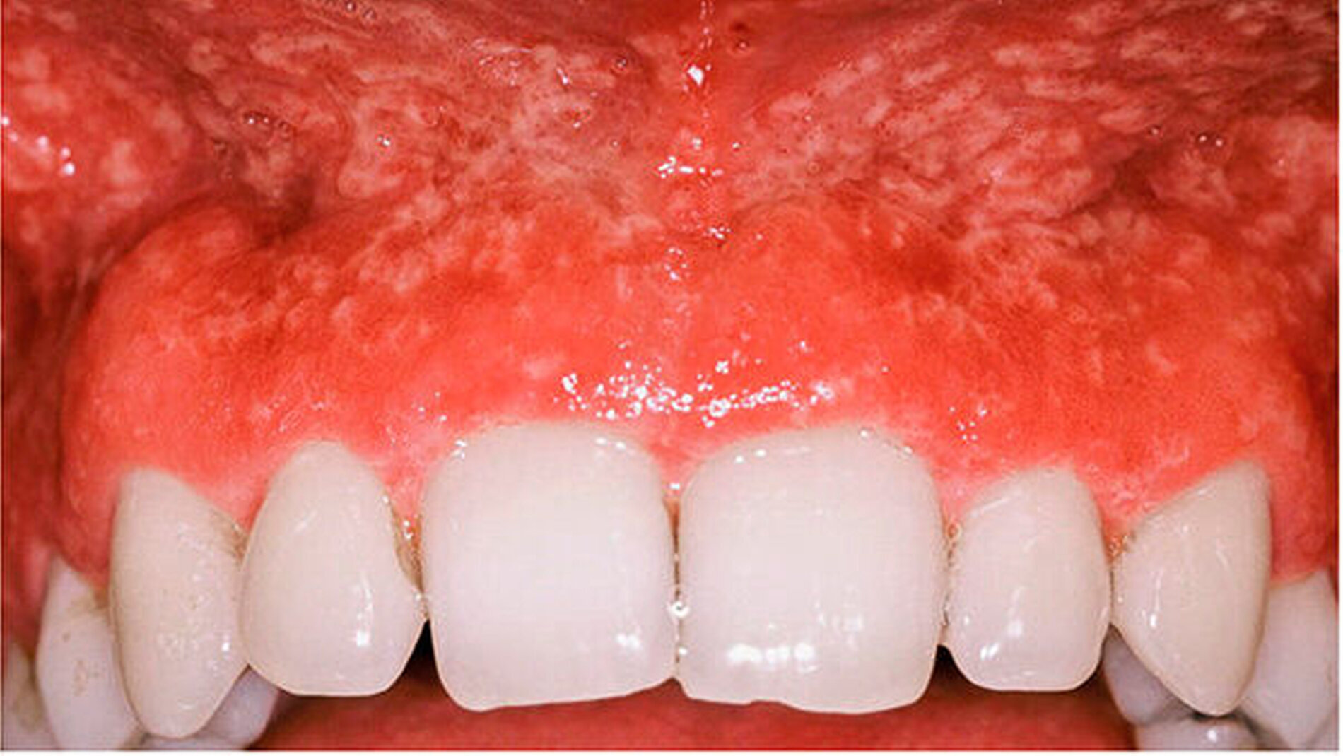 Der Fall: Pyostomatitis vegetans - zm-online