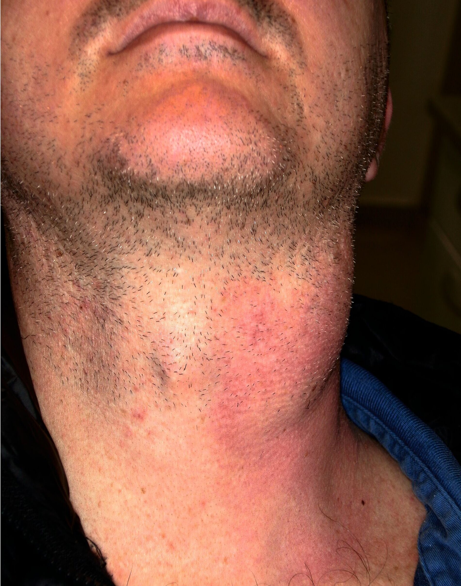 Ausgedehntes, progredient wachsendes Lipom der vorderen Halsregion - zm ...