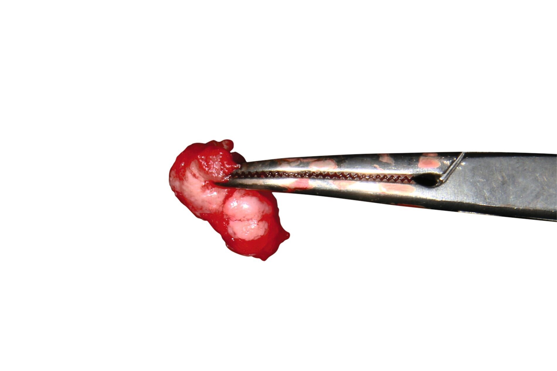 Enukleation einer nasopalatinalen Zyste - zm-online