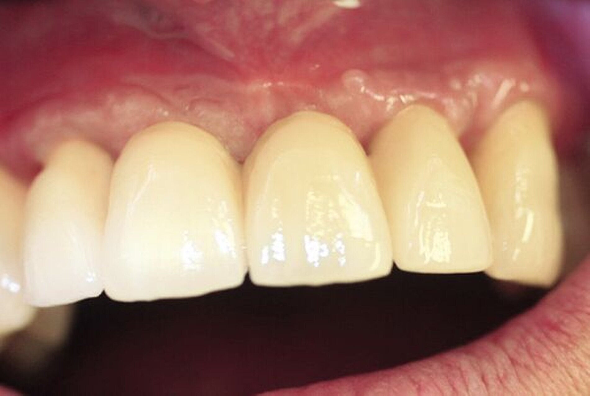 Konzepte zum Erhalt des Alveolarfortsatzes - zm-online