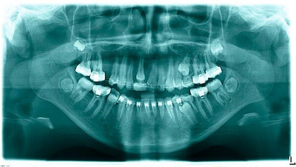 Therapie des dentalen Traumas bleibender Zähne - zm-online