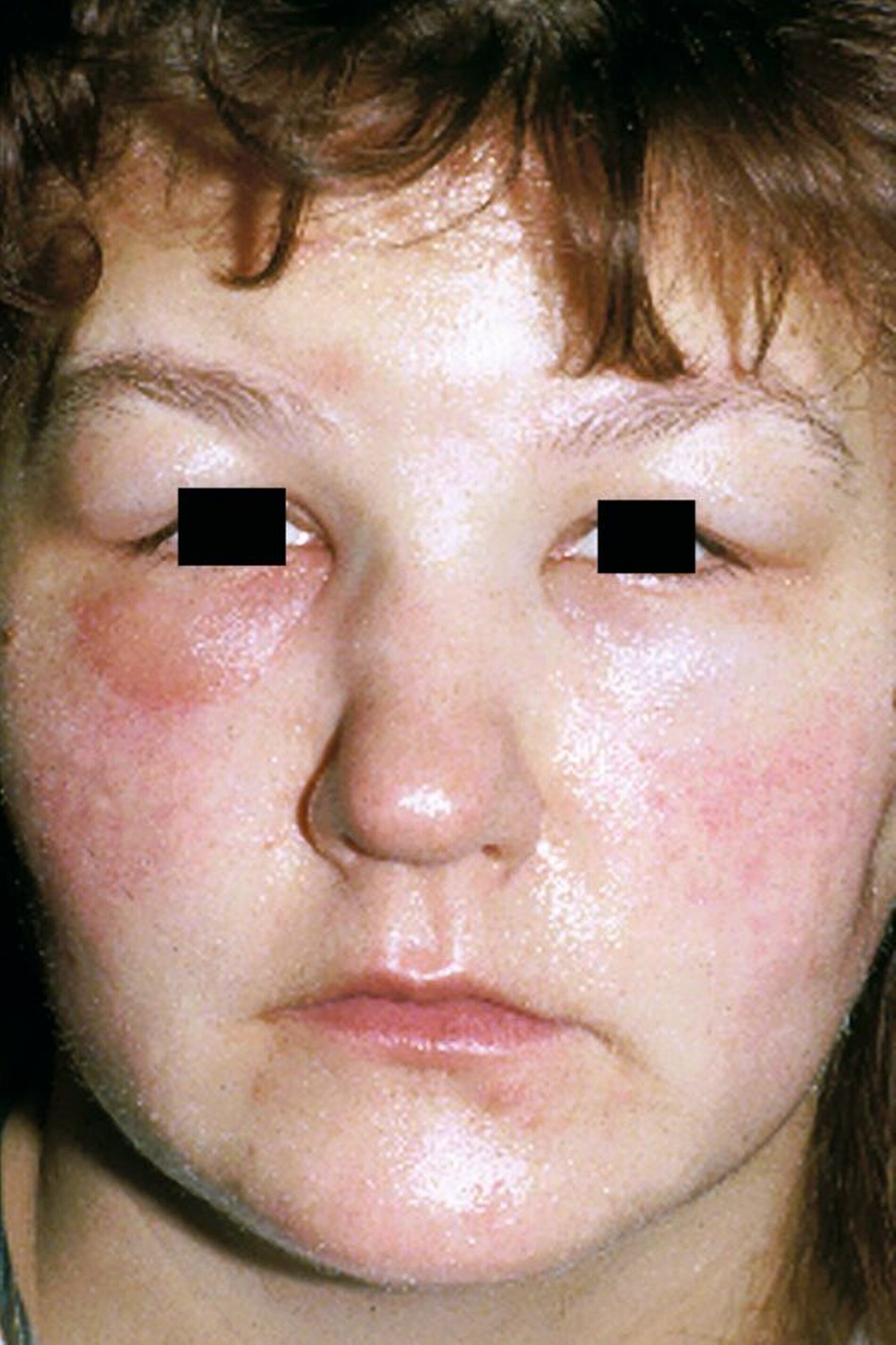 Angioödeme / Quincke-Ödem - zm-online