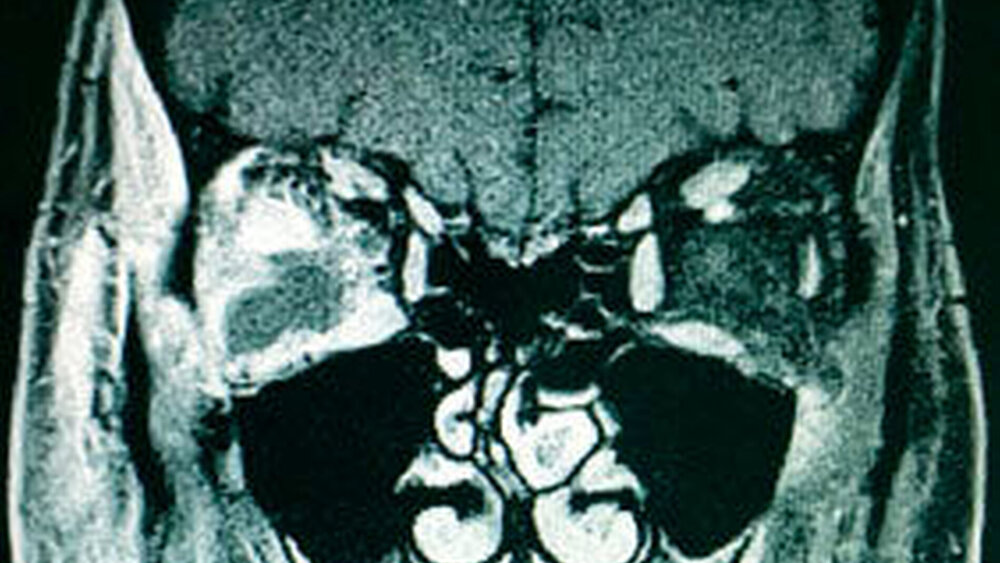 Orbitaabszess mit dentogener Ursache - zm-online