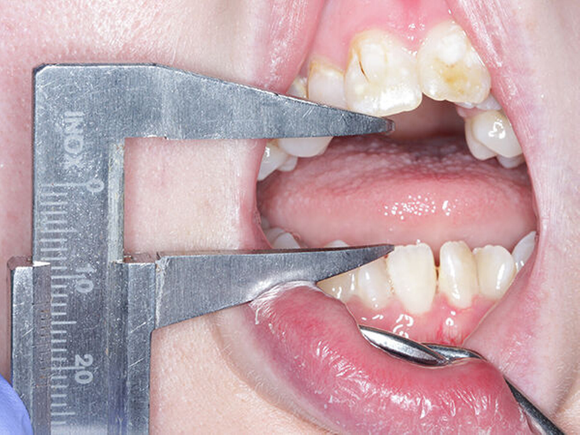 Trismus als Folgeerscheinung einer Erbkrankheit - zm-online