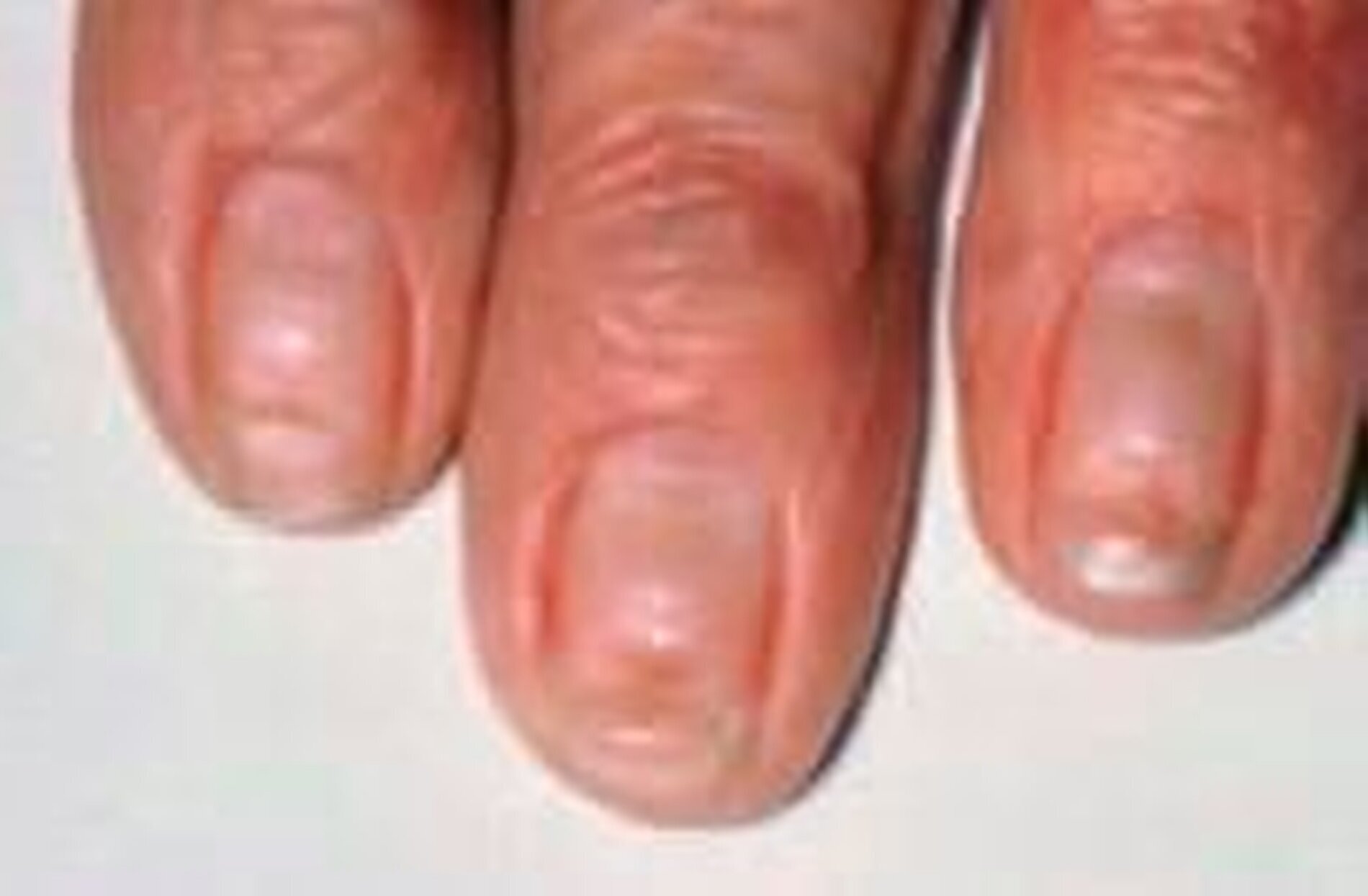 Wenn Dermatosen ihre Spuren in die Nägel graben\r - zm-online