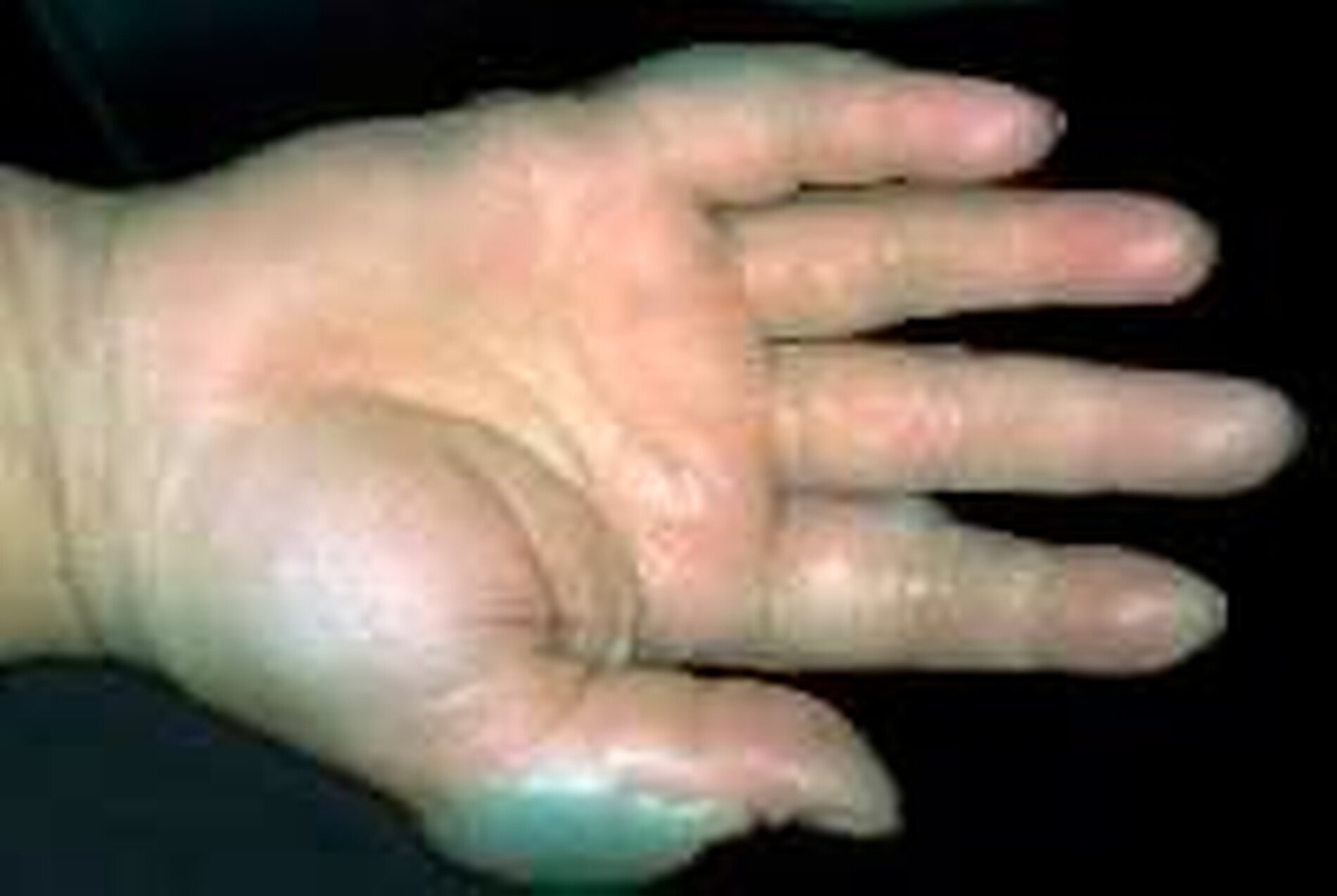 Verbrennungen und Verbrühungen - zm-online