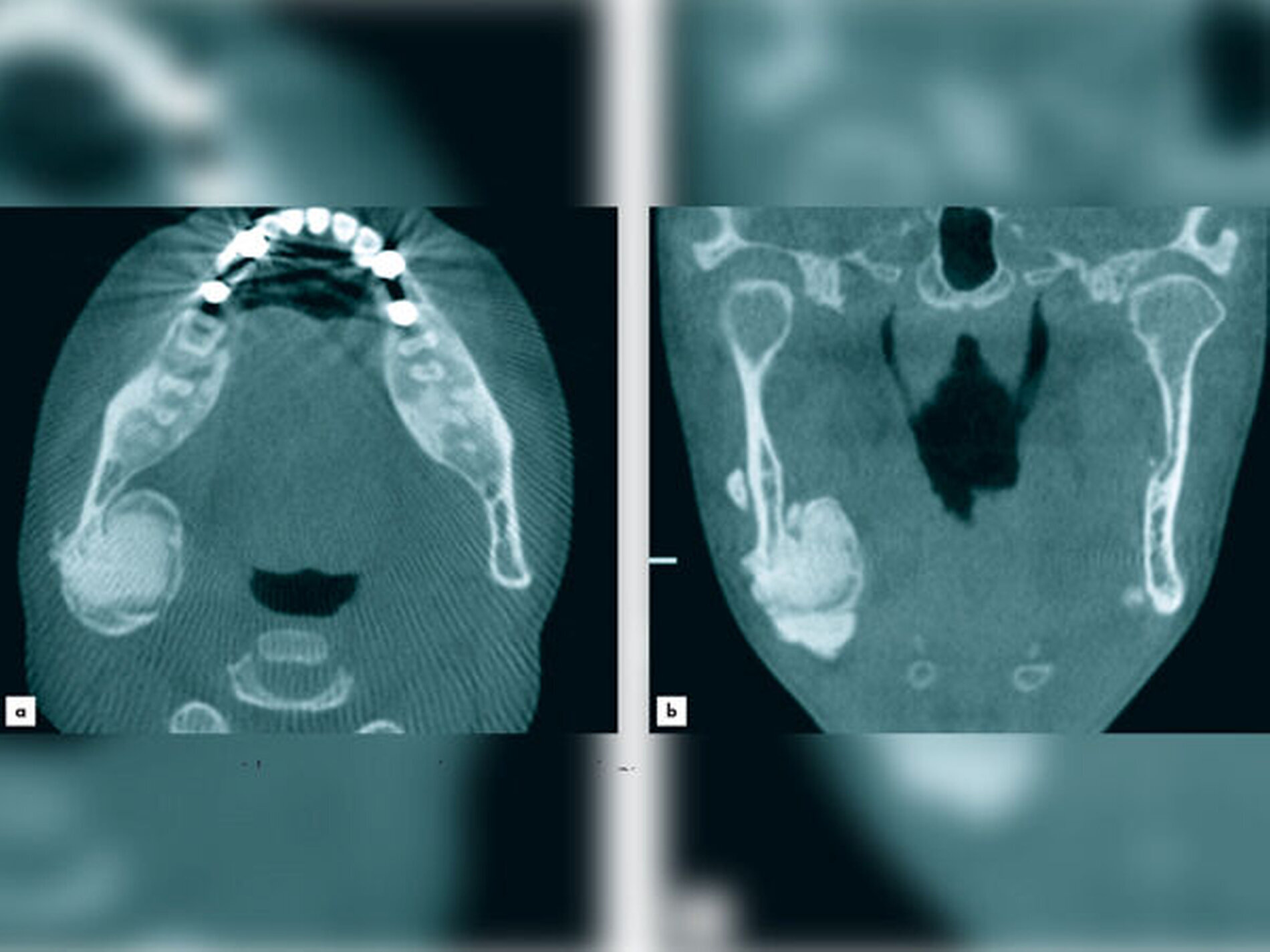 Fazial-multilokuläre fibröse Dysplasie - zm-online