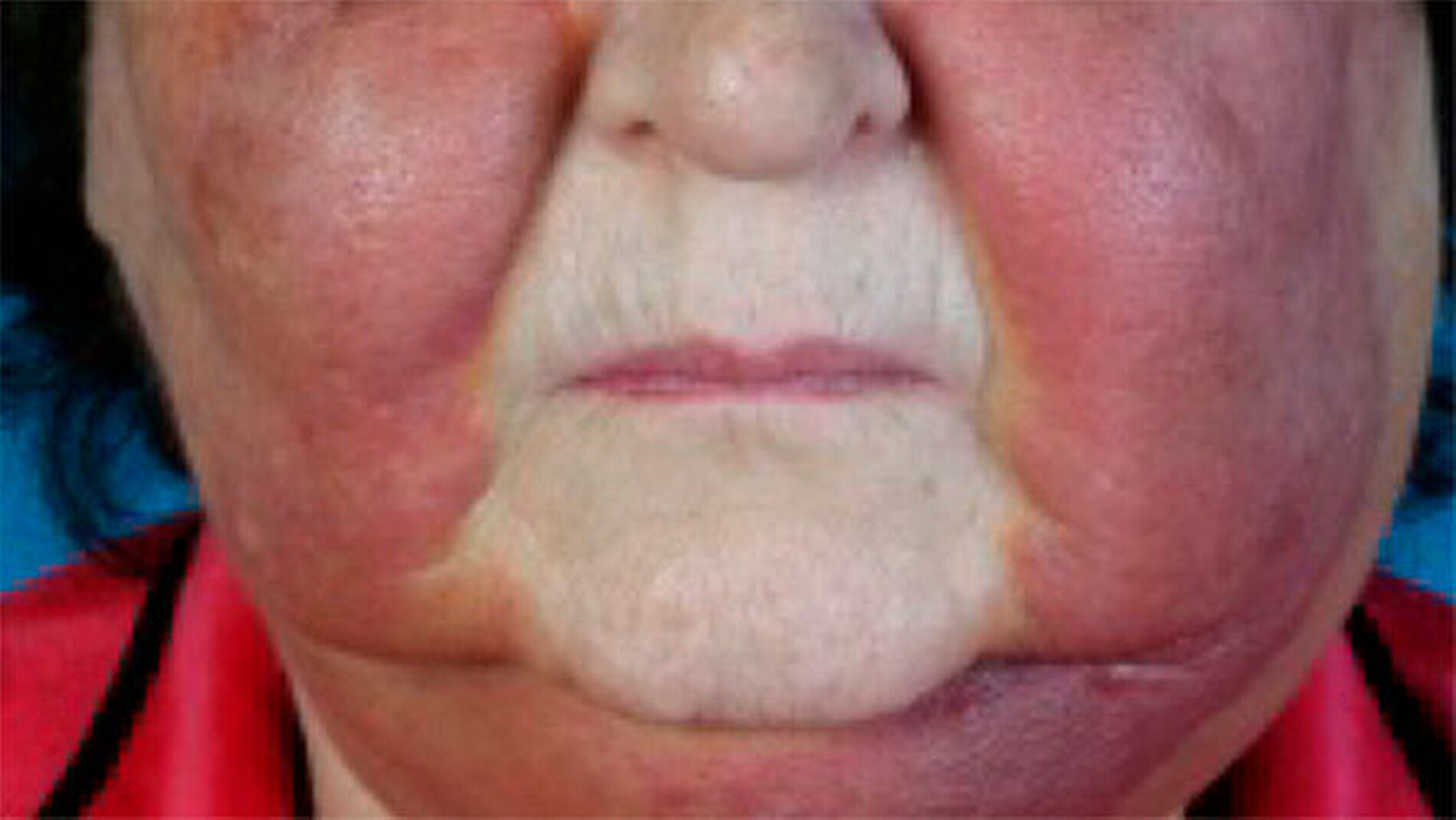 Angiosarkom-induziertes Gesichtsödem - zm-online