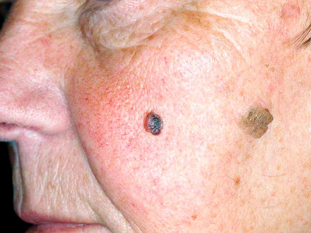 Tumore der Lippen und Gesichtshaut – das muss der Zahnarzt wissen! - zm ...