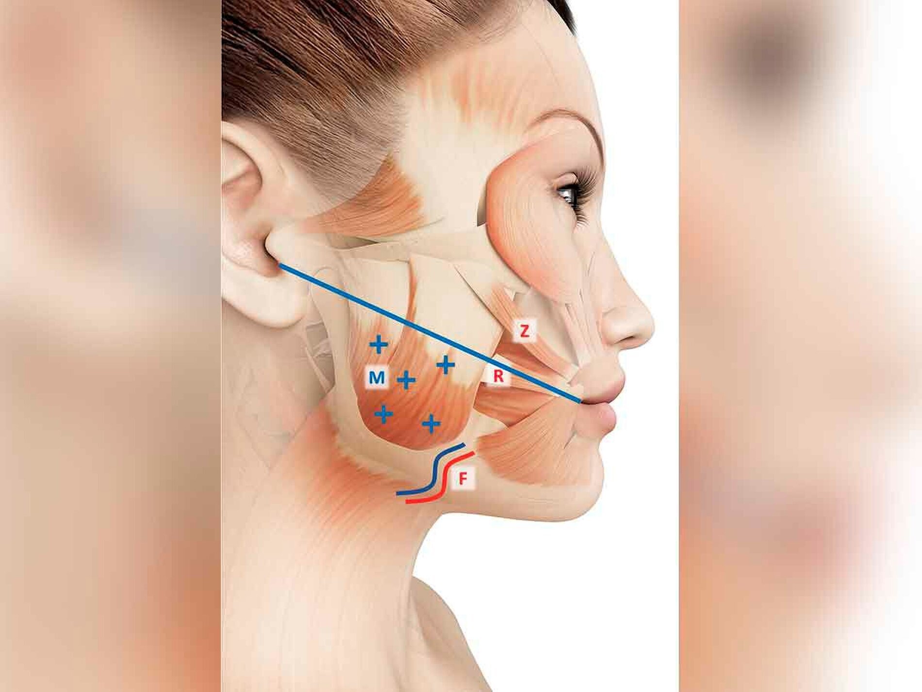 Botulinumtoxin in der Bruximustherapie - zm-online